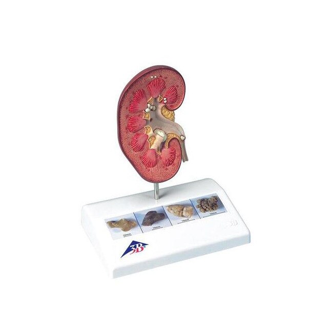 Kidney Stone Model | DiaMedical USA