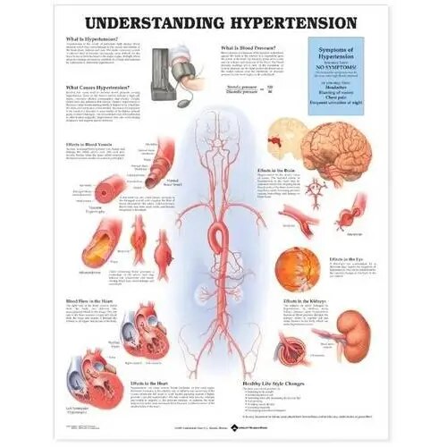 Lippincott® Understanding Hypertension Chart | DiaMedical
