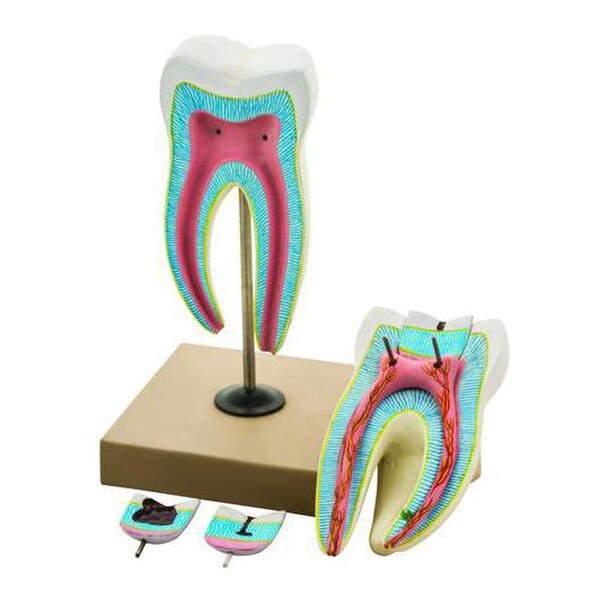 EISCO Upper Triple Root Molar with Caries Model | DiaMedical USA