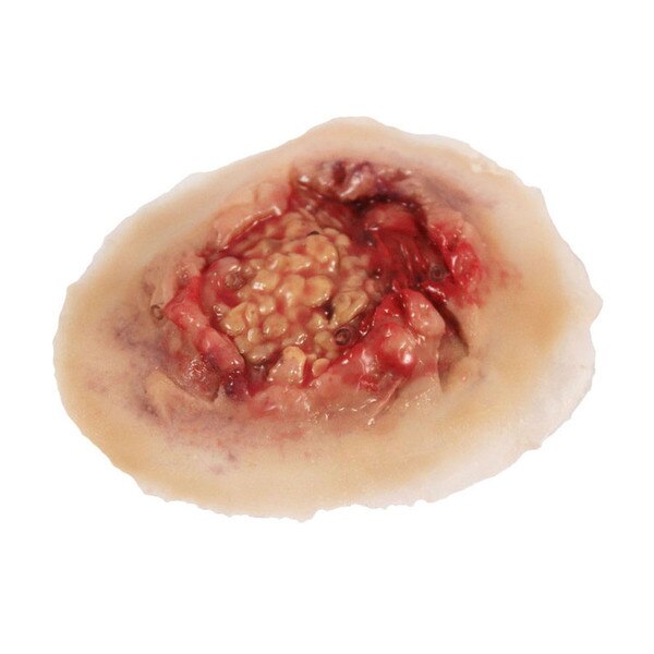 Moulage Sciences Simulated Adipose Tissue Wound | DiaMedical USA